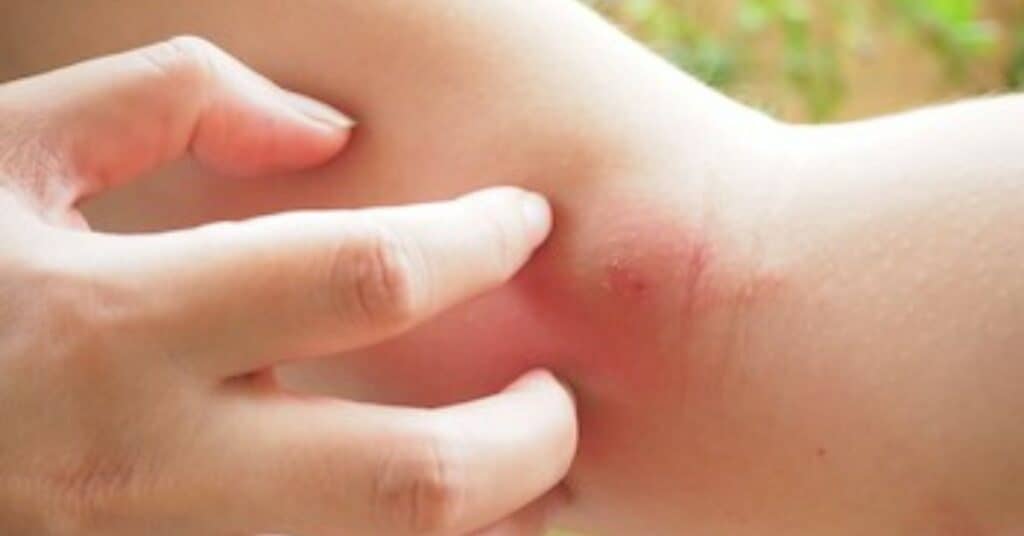 Wespensteek: Oorzaken, Symptomen en Wanneer Medische Hulp