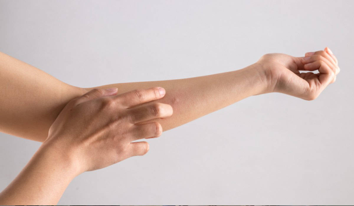 Wespensteek: Oorzaken, Symptomen en Wanneer Medische Hulp