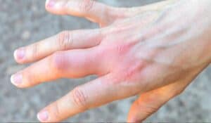 Wespensteek: Oorzaken, Symptomen en Wanneer Medische Hulp